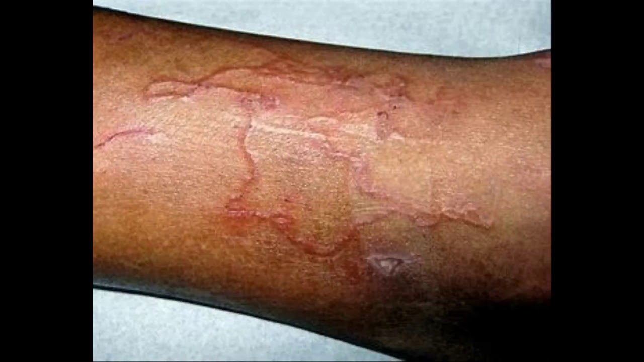 Hookworm- morphology, life cycle, pathogenesis, diagnosis and treatment ...