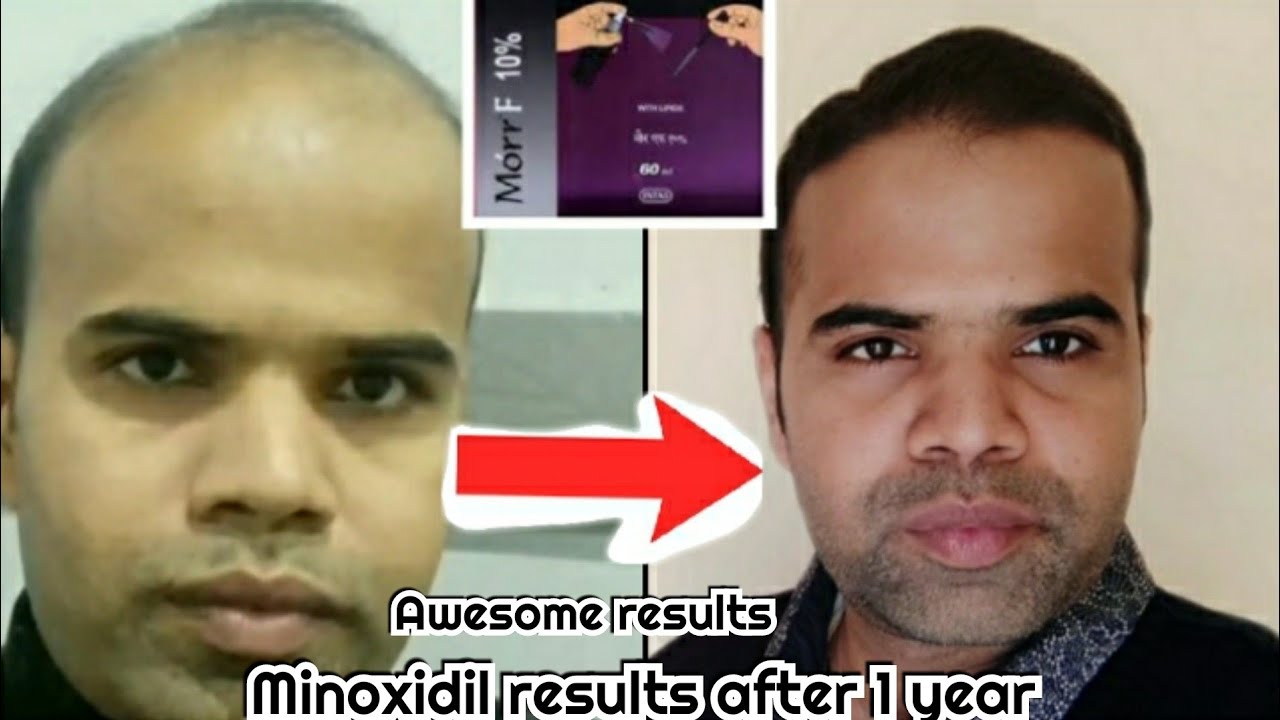 Minoxidil 10% + Follihair awesome results after 1 year. Visible scalp ...