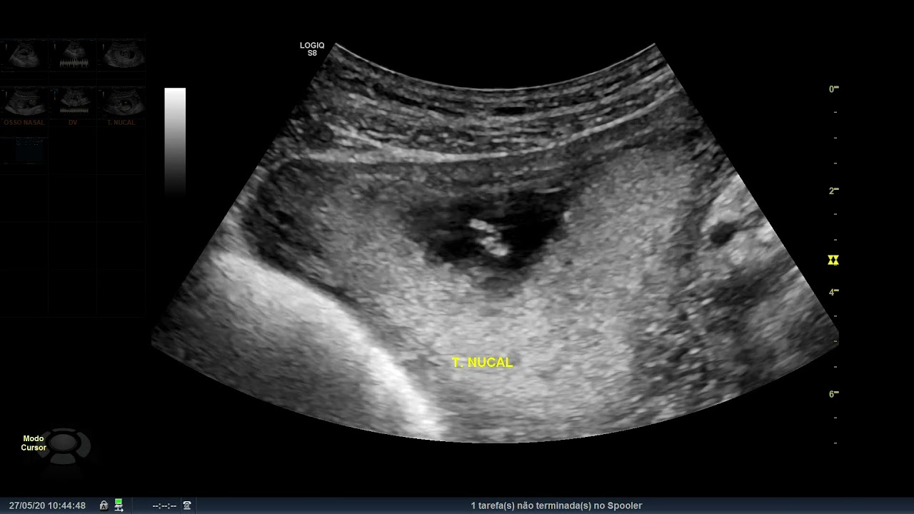 Nosso baby - Usg 13 semanas - YouTube