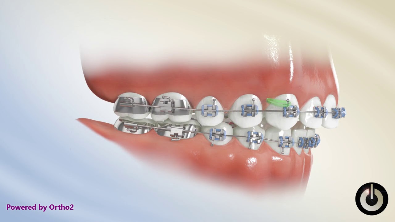 Elastics, Class II Box | Dental Braces | Temecula Valley, CA - YouTube