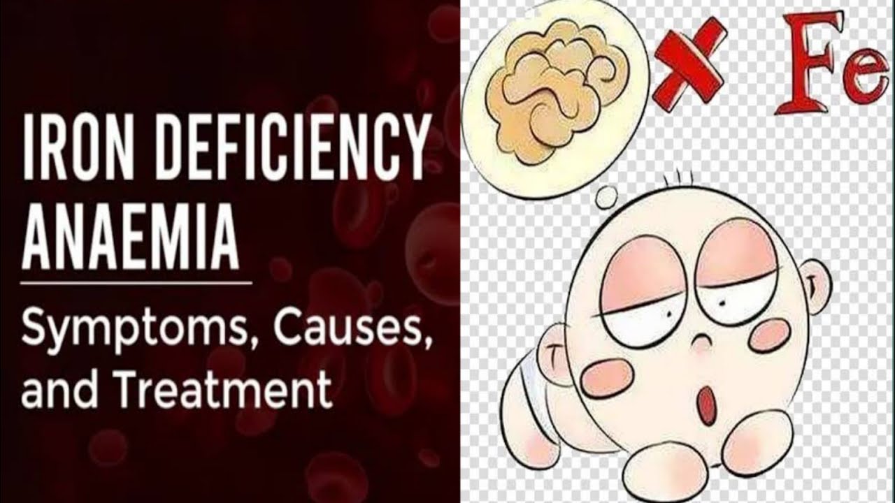 Iron deficiency anemia || iron ki kami - YouTube