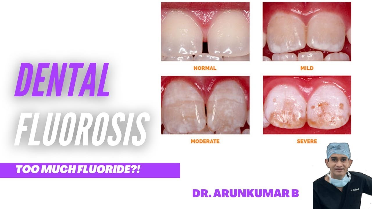 Dental Fluorosis & its Effect on Teeth | Dr Arunkumar Pearls Dentistry ...