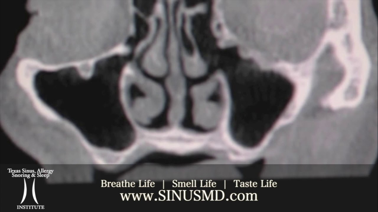SINUS CT SCANS BEFORE AND AFTER SURGERY - YouTube