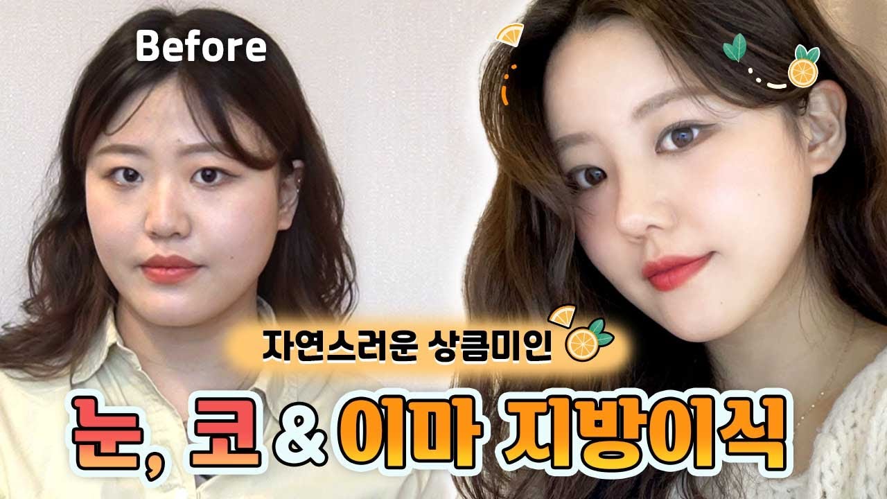 성형브이로그 ️자연스럽게 예뻐지는 법 ️성형 후 한 달 차 변화과정and리뷰 코성형브이로그 자연유착 이마지방이식 코성형