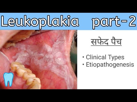 Etiopathogenesis and Clinical Types of Leukoplakia #easydent - YouTube
