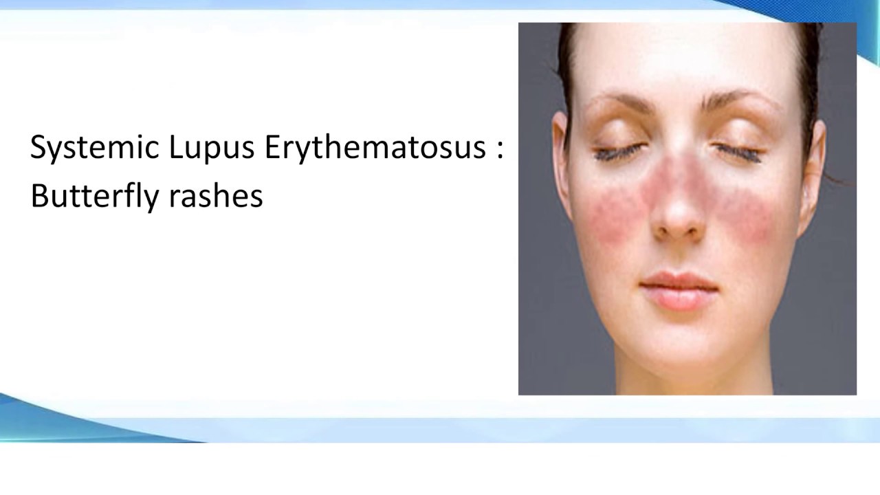 Pathognomonic Signs - YouTube