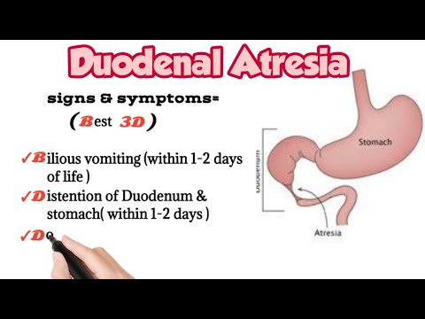 duodenal atresia signs and symptoms - YouTube