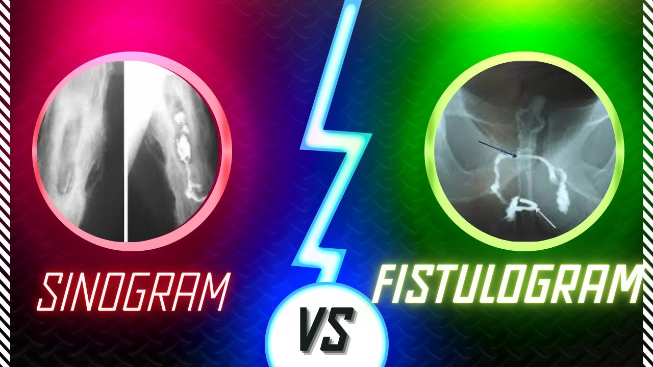 Sinogram vs Fistulogram|X-ray Procedure Sinogram vs Fistulogram|In Urdu ...