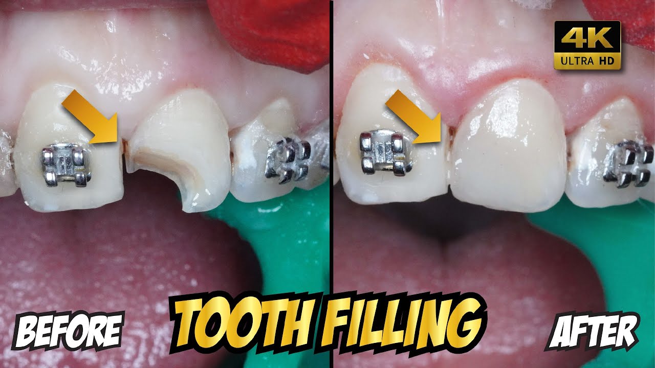 Proses Penambalan Gigi Patah | Dentist | Dokter Gigi Tri Putra - YouTube
