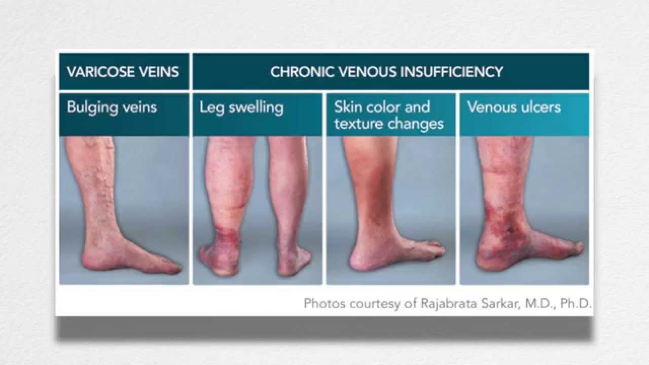Vascular Associates, Dr Bud Shuler, Explains Venous Disease and Risks ...