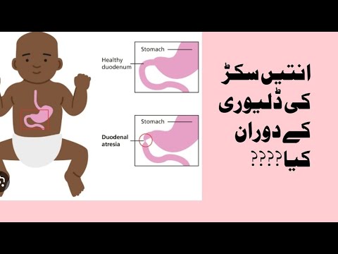 fetal duodenal atresia shown by ultrasound/double bubble sign/fetal ...