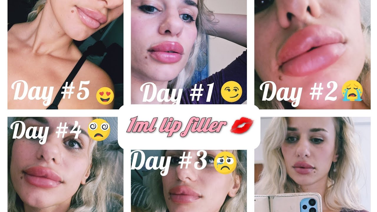 ΕΒΑΛΑ ΥΑΛΟΥΡΟΝΙΚΟ ΣΤΑ ΧΕΙΛΗ 💋 - 1ml lip filler 💋 / ΑΜΑΡΙΛΝΤΑ ΒΑΛΑΒΑΝΗ 💗 ...