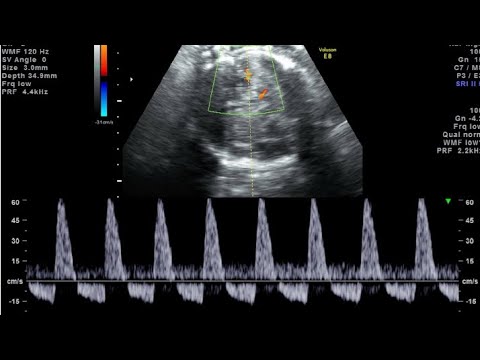 umbilical artery Doppler... Reverse End diastolic flow ..Fetoplacental ...