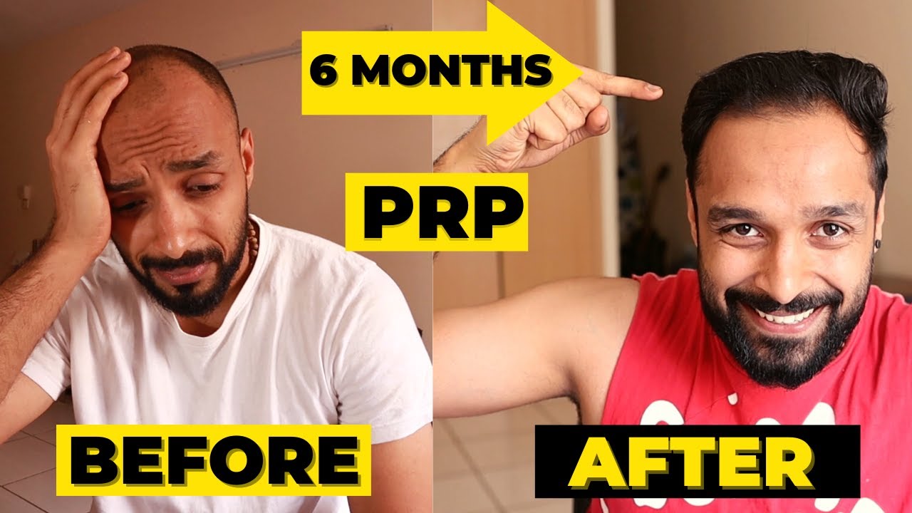 PRP 6 MONTH RESULTS - 3 PRP sessions | HAIR TRANSPLANT vs PRP which one should you really go for ...