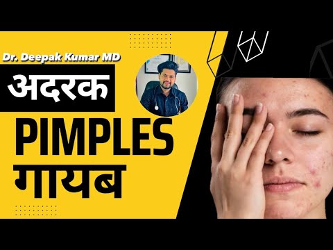 अदरक से पिंपल्स गायब | How to remove pimples | Dr. Deepak Kumar BAMS, MD #acne - YouTube