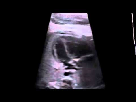 Normal left ventricular outflow tract (LVOT) - YouTube