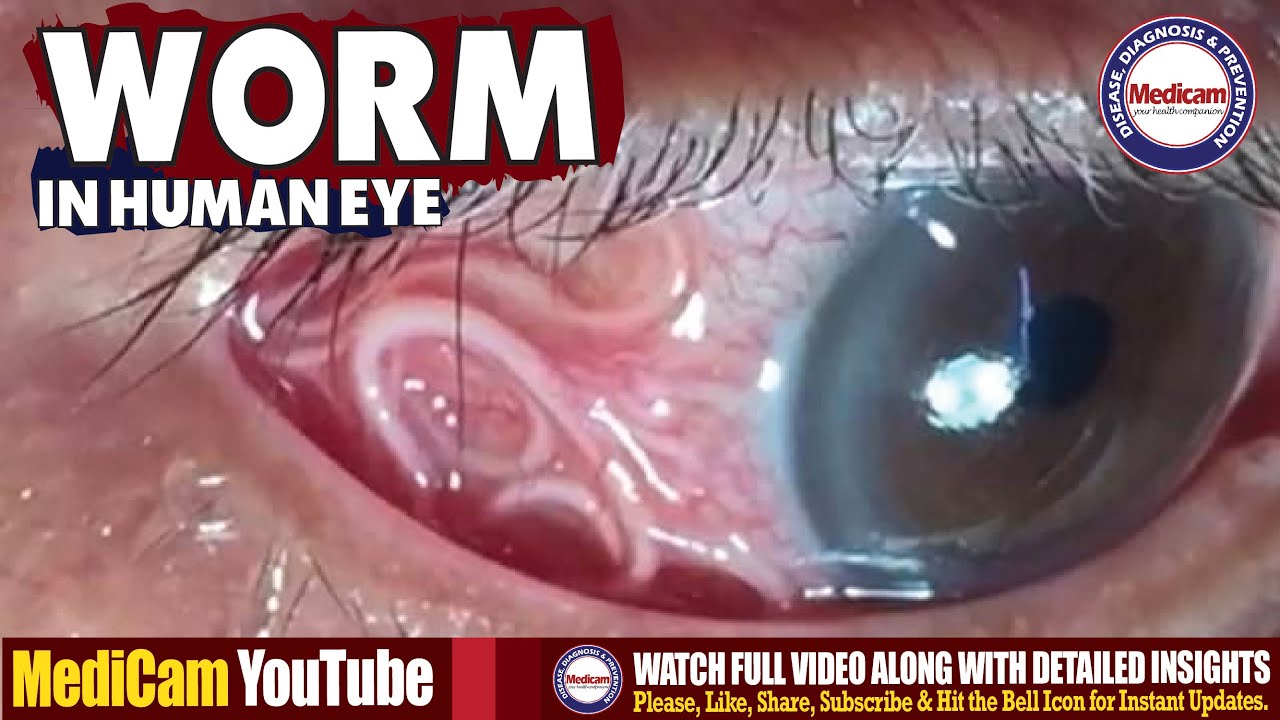 Ophthalmology | Worm in Human Eye Causes & Extraction Process | Eye ...