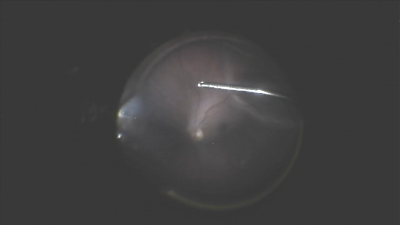 A case of infero temporal retinal detachment - YouTube