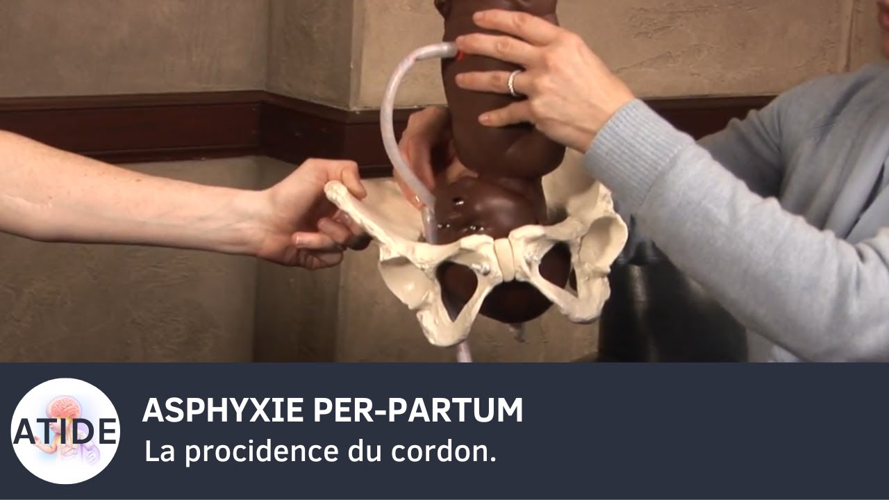 La procidence du cordon. - YouTube
