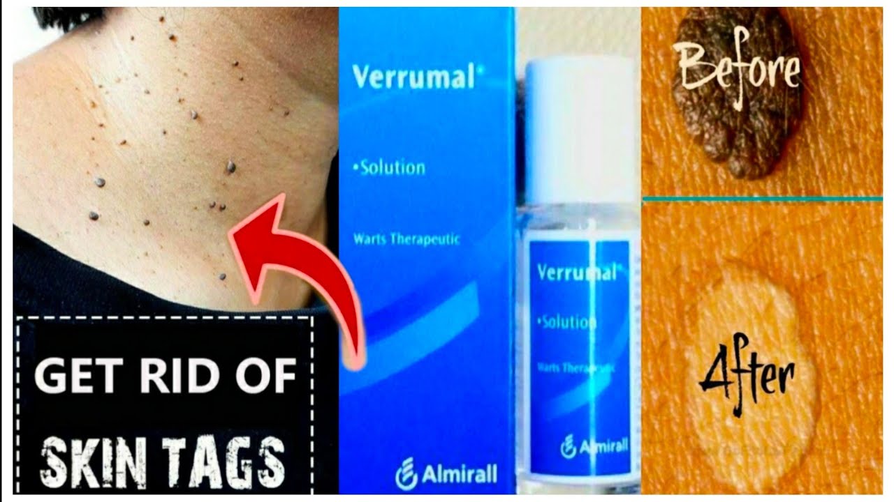 Doctor Tips For Warts | 3 நாட்களில் மருக்கள் உதிரும் / warts removal ...