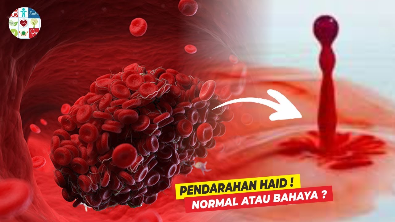 PENYEBAB DAN CARA MENGATASI PENDARAHAN BERLEBIH SAAT HAID, INILAH ...