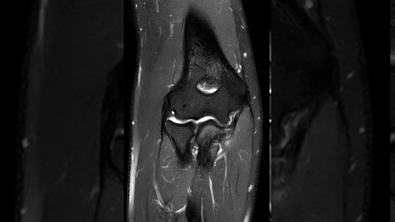 Ulnar collateral ligament (UCL) tear and cortical avulsion from the ...