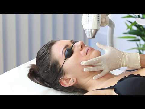 EME - Epil Evo, trattamento con laser a diodo su labbra