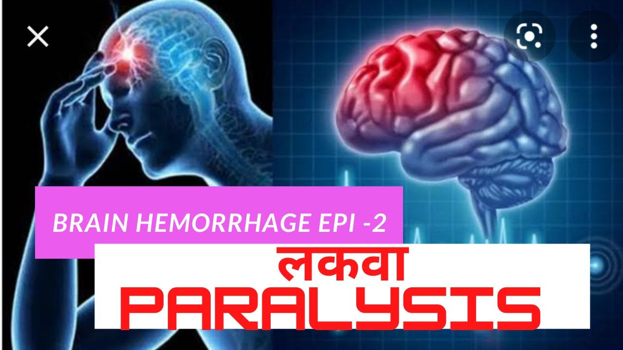 brain hemorrhage epi 2 ,lakwa , paralysis , brain stroke, lakwa karan ...