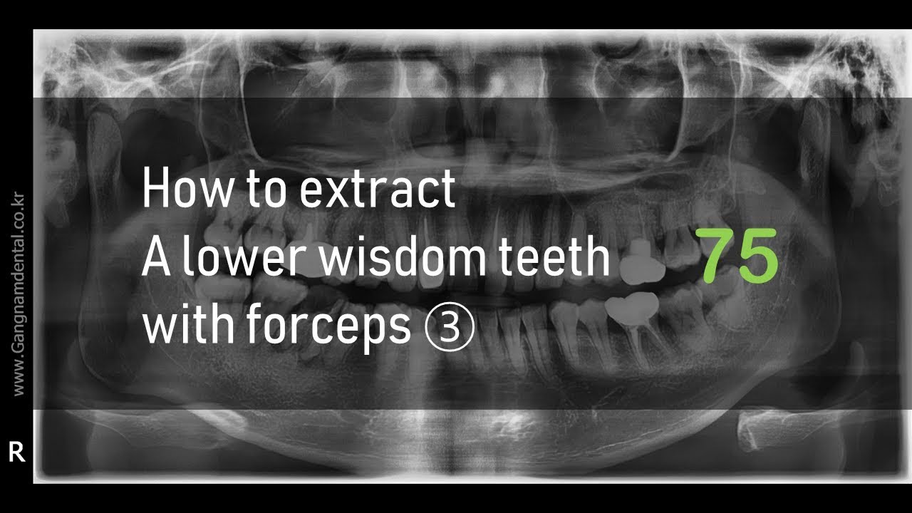 Lower wisdom tooth Removal with forceps - YouTube