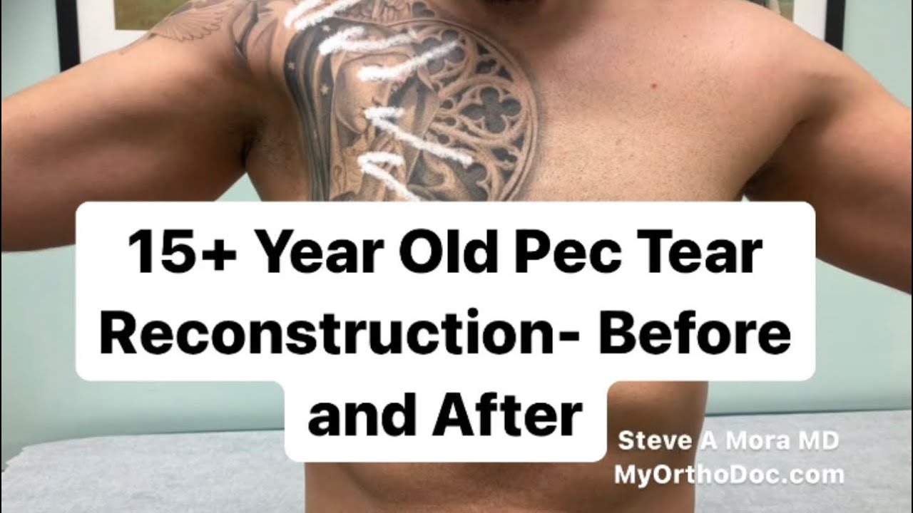 Can An Old Pec Major Tear Be Repaired #moramd - YouTube