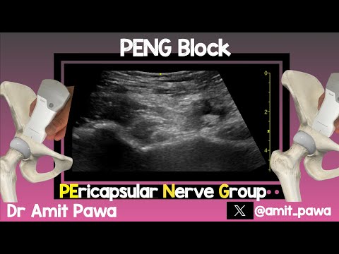 PENG Block