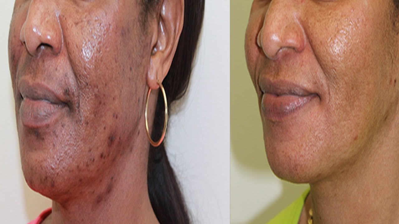 Comment enlever rapidement les taches sur le visage ? Éclaircir les ...