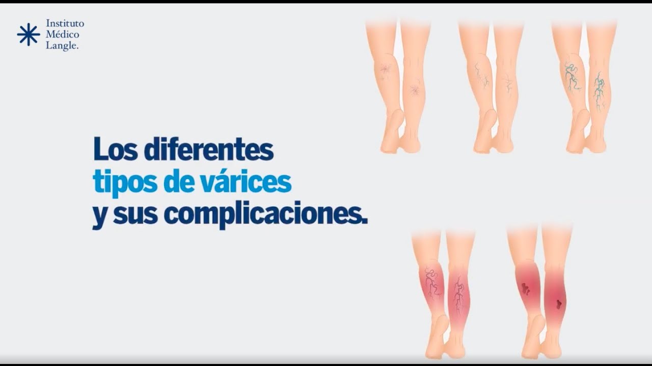 ¿cuáles Son Los Tipos De Várices Y Como Identificarlas Youtube