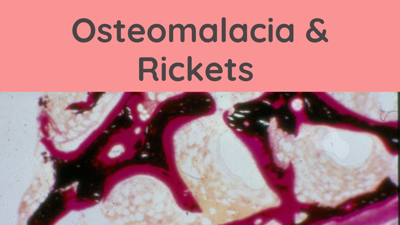 Osteomalacia and Rickets - Pathology mini tutorials - YouTube