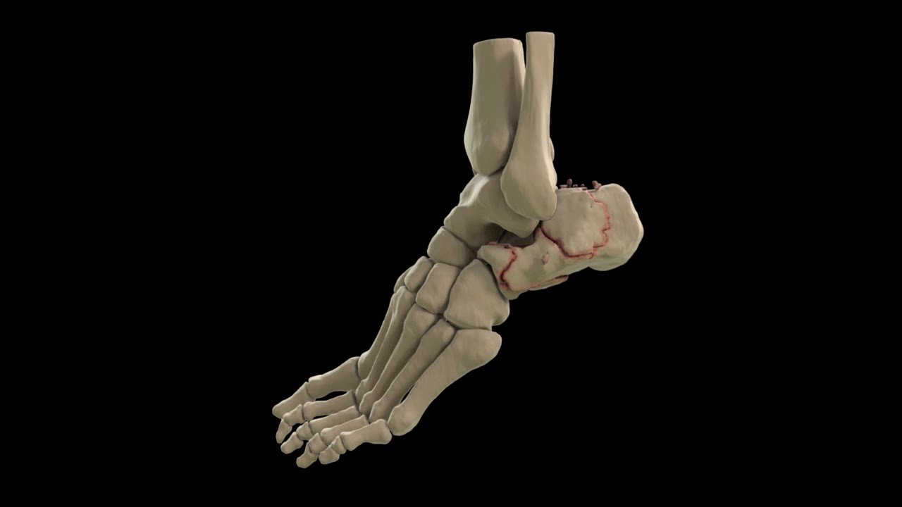 3D Volumetric Rendering of Calcaneus Fractures - YouTube