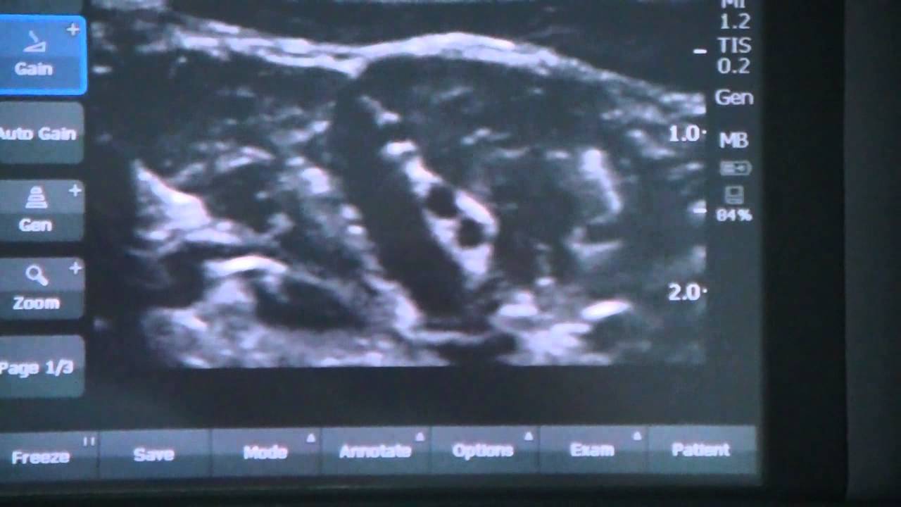 Ultrasound Guided Interscalene Branchial Plexus Block-251 General Air ...