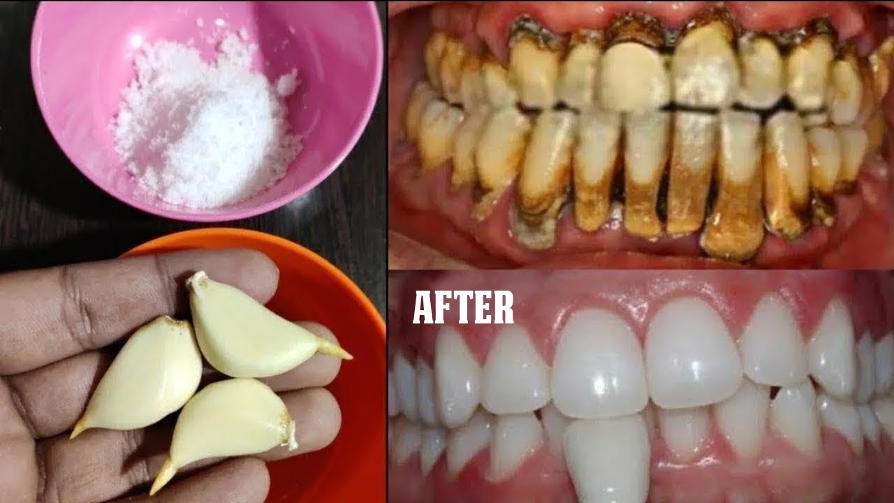 Teeth whitening at home in 3 minutes || How to naturally whiten your ...
