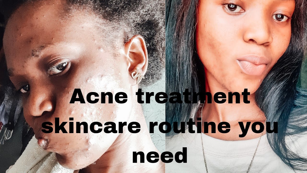 How to get rid of acne and dark spots in 1 month? || Skincare Routine ...