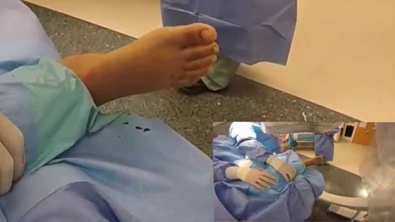 Hyprocure Implant - Alliance Community Hospital Podiatric Residency ...