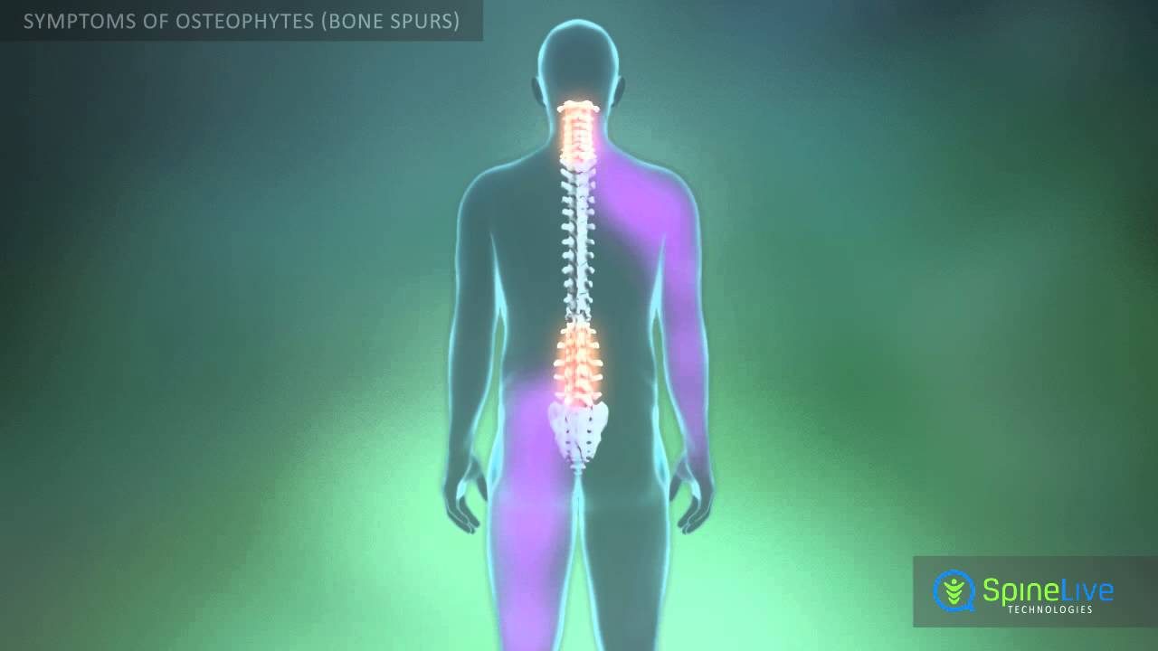 Osteophytes bone spurs Symptoms - YouTube