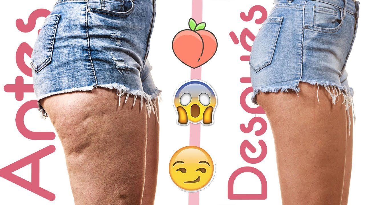 Cómo eliminar la CELULITIS RÁPIDO, en 1 SEMANA 🦵🏼notarás la diferencia ...