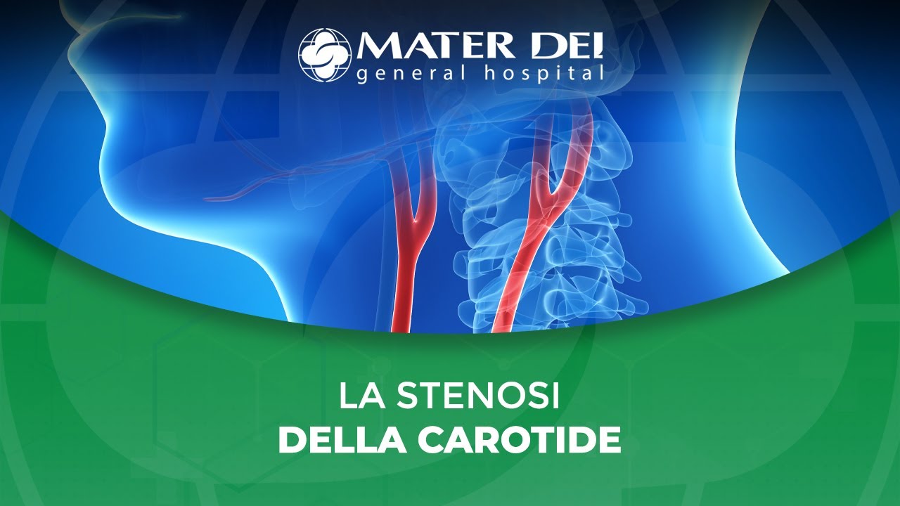 La stenosi della carotide - YouTube