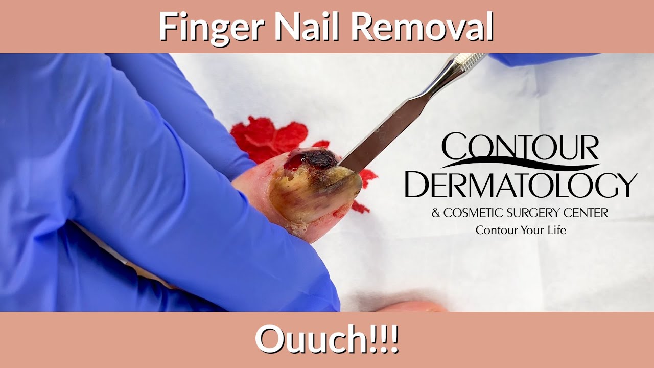 Fingernail Removal | Contour Dermatology - YouTube