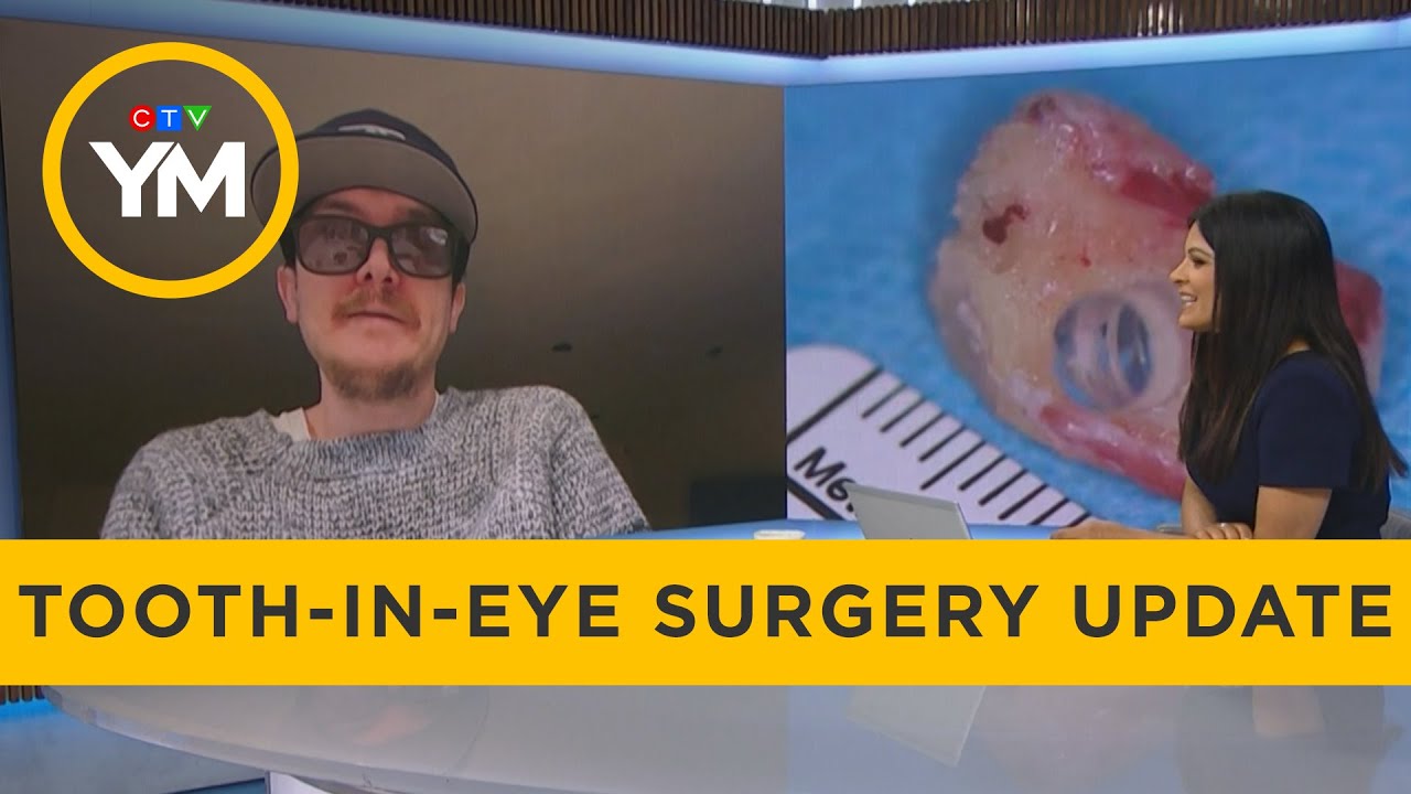 Man’s Vision Restored After Revolutionary Tooth-in-Eye Surgery | Your ...