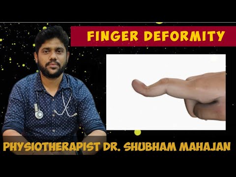 Finger deformity | flexion injury | Rehabilitation | Physiotherapy ...