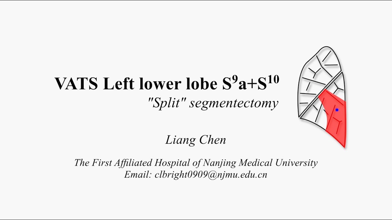 VATS: Left Lower Lobe S9a+S10 Split Segmentectomy - YouTube