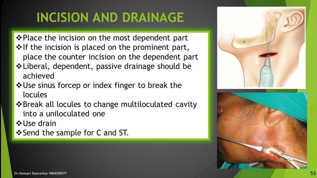 Incision Drainage Case Report - YouTube