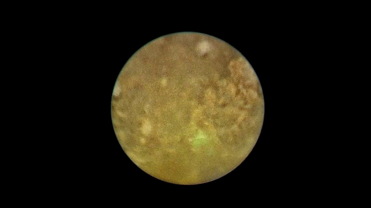 urinary bladder stone vesical calculus laser lithotripsy with thulium ...