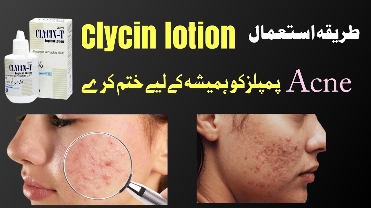 Clycin T lotion benefits | clindamycin lotion | remove pimples | clycin ...