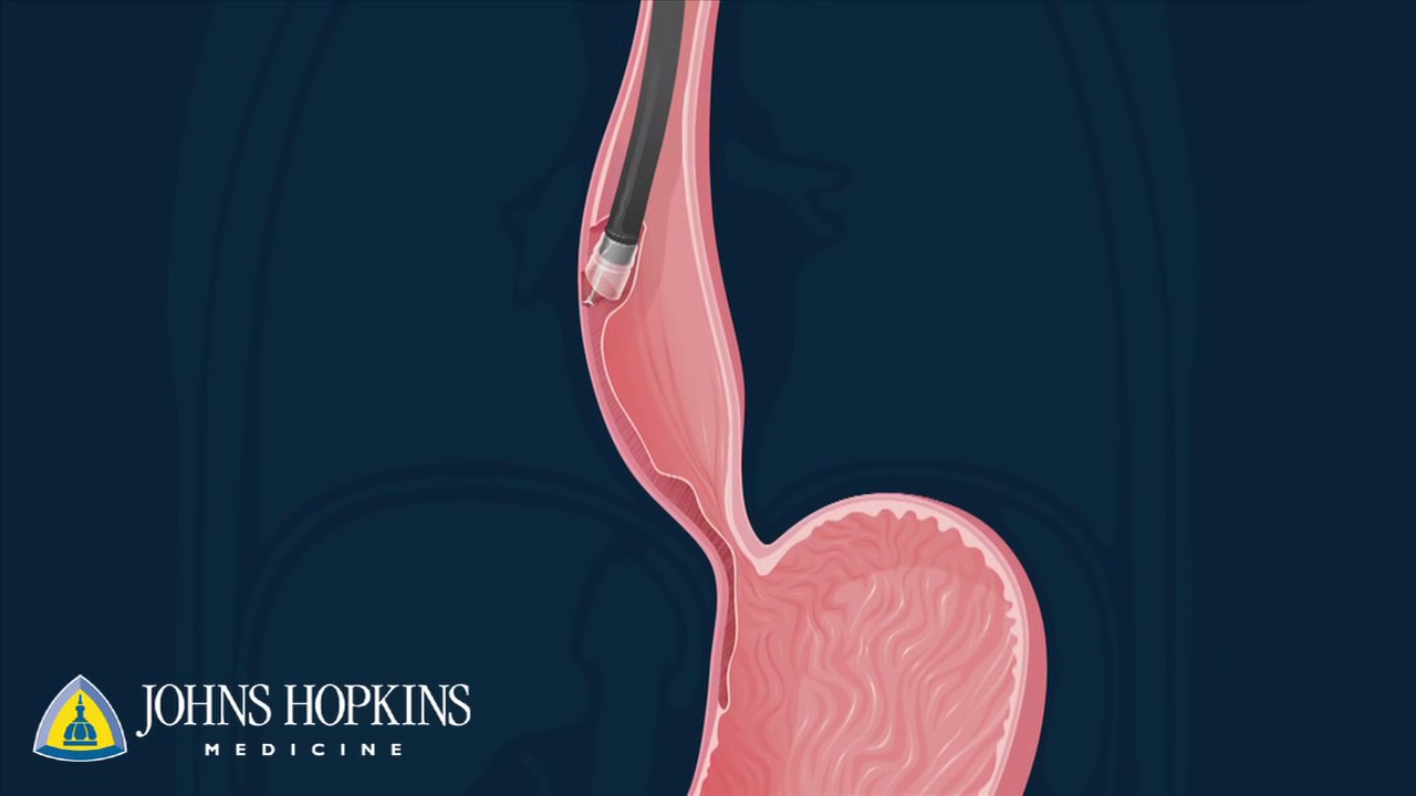 MIOTOMIA ENDOSCOPICA - YouTube